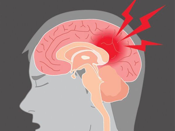 symptoms of a thunderclap headache | સખત માથું દુખે અને સહન ન થાય એ હદે ...