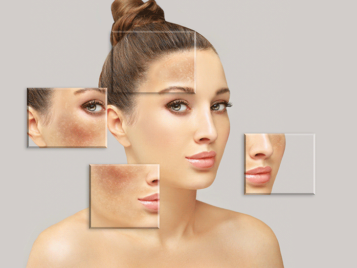The truth about facial pigmentation or melasma