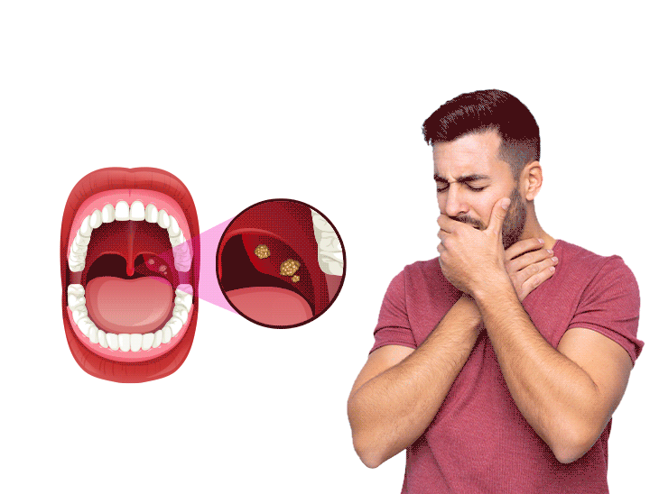 Tonsillitis: Doctor Explains Symptoms, Causes & Prevention
