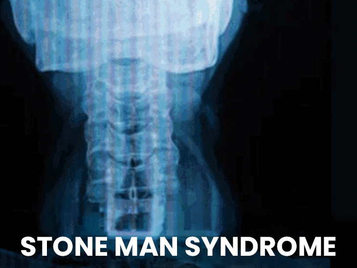 Rajasthan Child Diagnosed with Stone Man Syndrome | Rare Disease