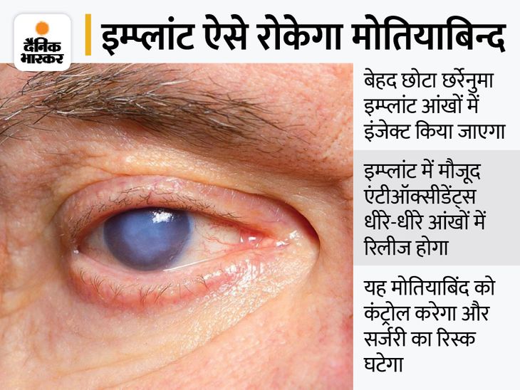 Motiyabind Cataract Prevention; Scientists Develop Pellet Implant That ...