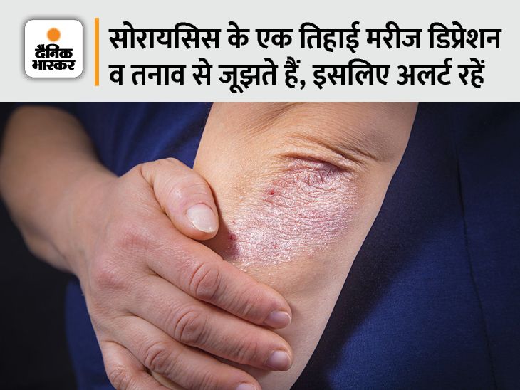 World Psoriasis Day; Everything You Wanted To Know About Skin Disease ...