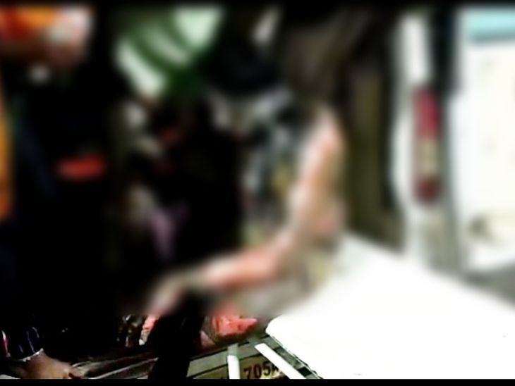 Set himself on fire, the doctor said - 70 percent scorched body | बैतूल ...