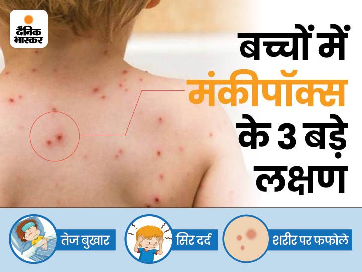 US Monkeypox Cases Update; 31 Children Infected By Virus In 11 States