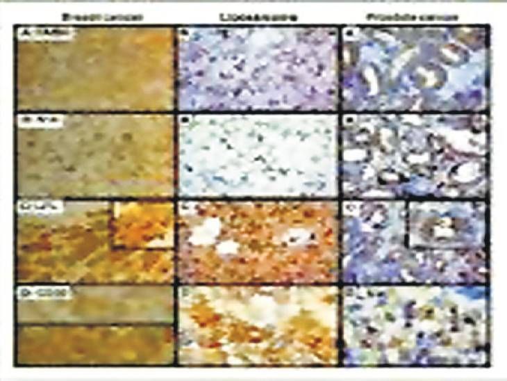Cancer detection test in 7 days stopped from 30 days, due to no IHC ...