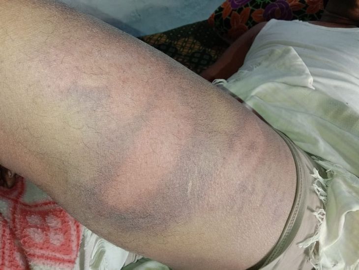 Forest Department officer beat and broke his head, there were marks on ...