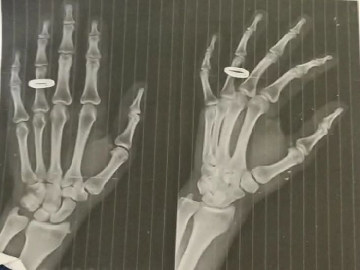 There is no X-ray film in the district hospital named after Scindia's ...