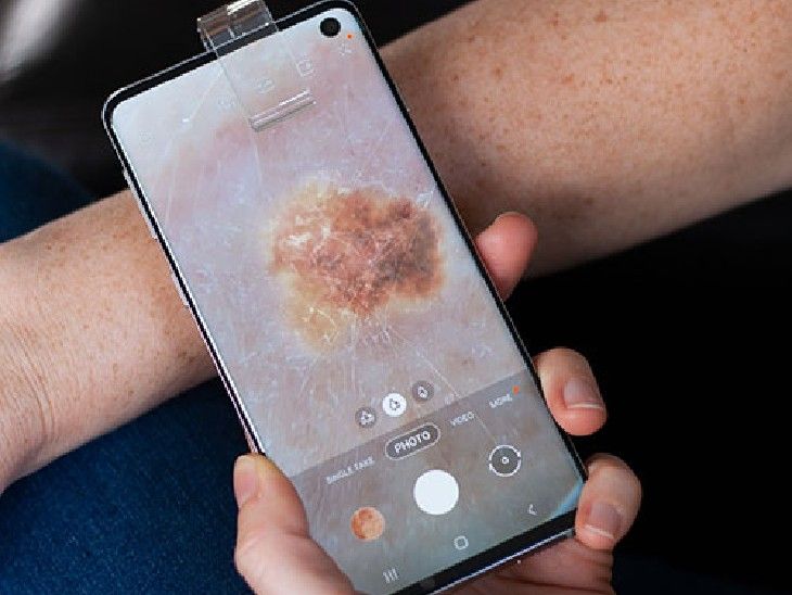 Smartphone camera lens technology to be used to diagnose Skin cancer