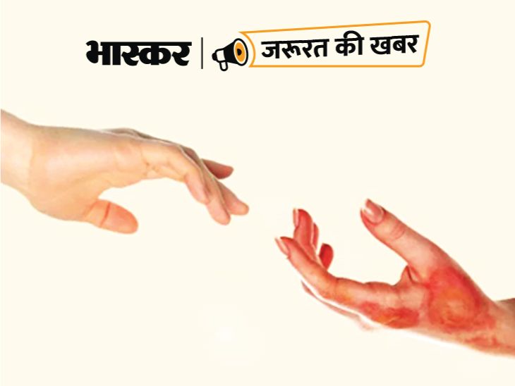 Delhi Skin Bank; Skin Donation Process Explained (How Skin Bank Work)