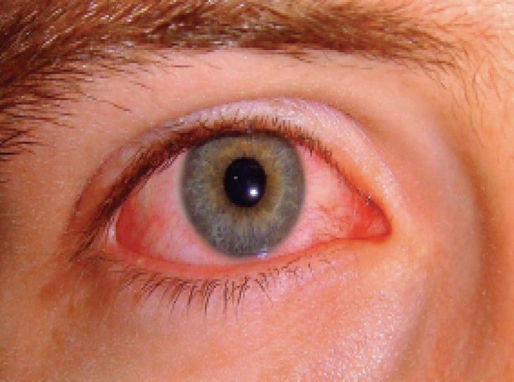 Pink eye disease spread in many areas of the capital, symptoms starting ...