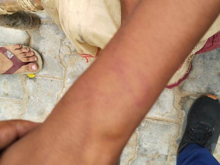 Serious injury marks of beating with a stick on legs and hands ...