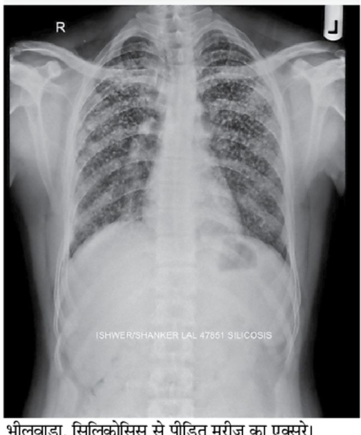 Deadly silicosis: One out of every 10 mine workers suffers from lung ...