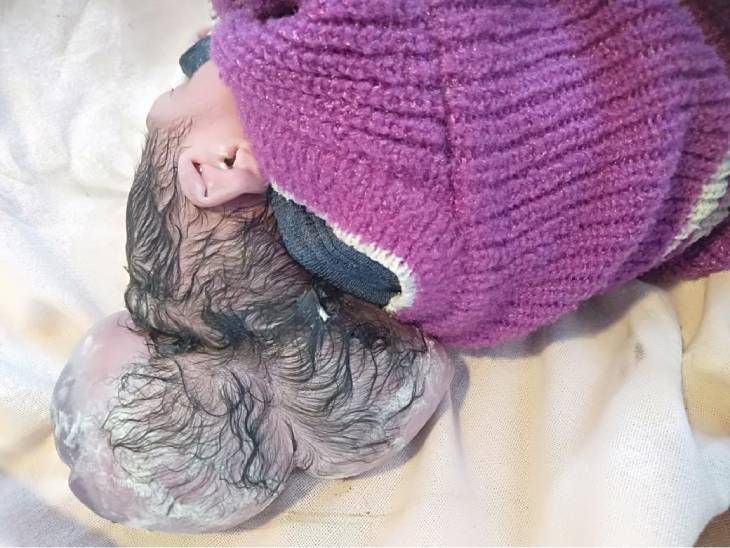 Three-headed girl born in Meerut