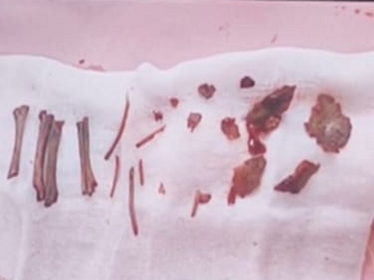 22 pieces of bones removed from woman's uterus