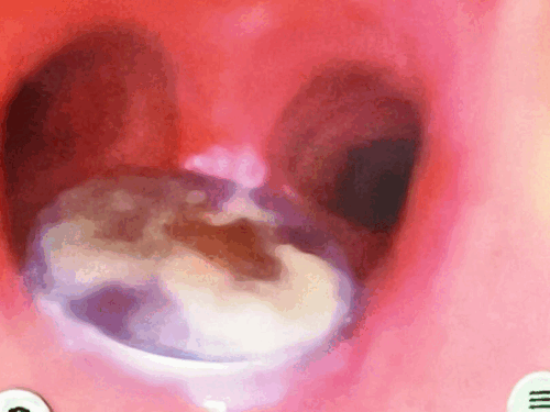 25 paise came out from the patient's windpipe | मरीज की श्वांस नली से ...