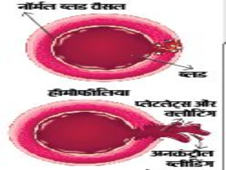 RMSCL has stopped supplying 'effective' medicine for haemophilia ...