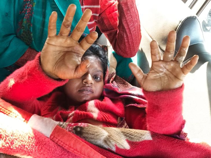 Woman burnt with hot iron rod after giving birth to a daughter