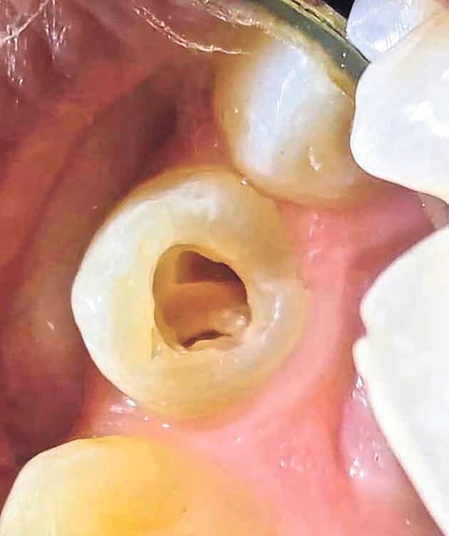 Tooth inside tooth: Rare disease treated at MGH | दांत के अंदर दांत ...