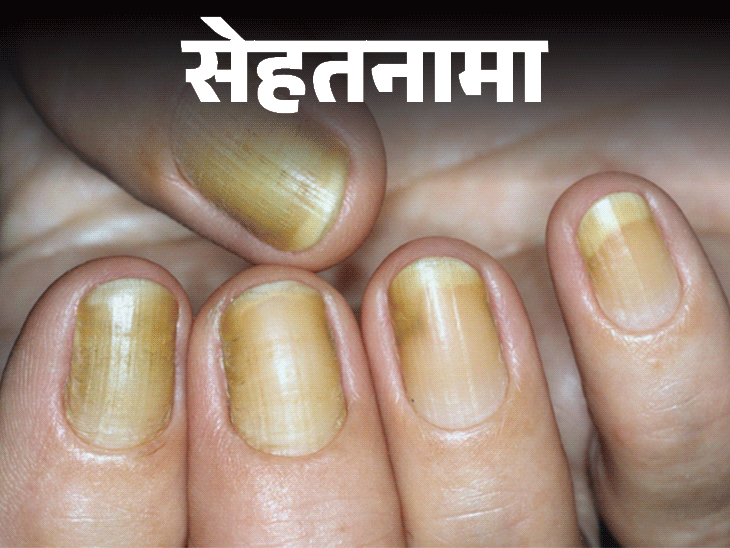 Nail Diseases Chart; Fingernail Color Health Signs & Symptoms
