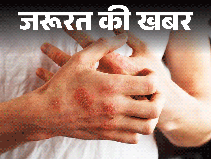 Skin Disease; Summer Fungal Infection Signs & Symptoms Explained ...