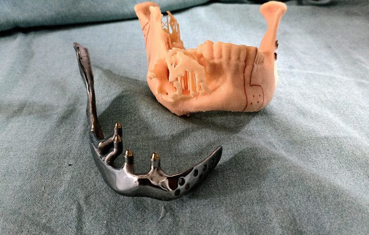 First successful jaw replacement surgery done in a private hospital ...