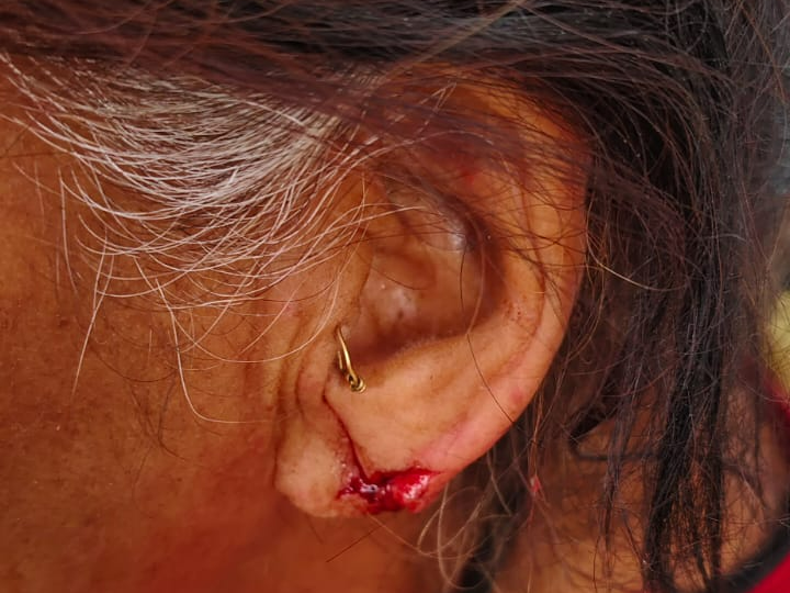 In Agra's Pinahat, a woman's earring was torn and broken | आगरा के ...
