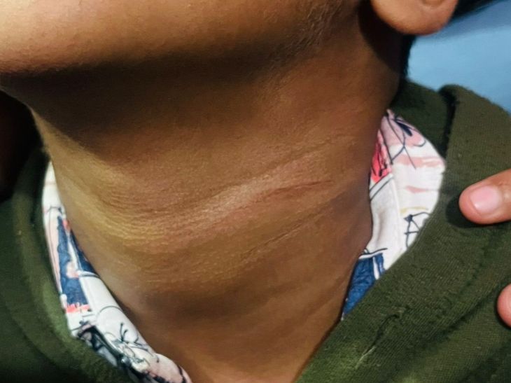 Prayagraj Kite String Injury: Child Hurt on Bike, Big Accident Averted
