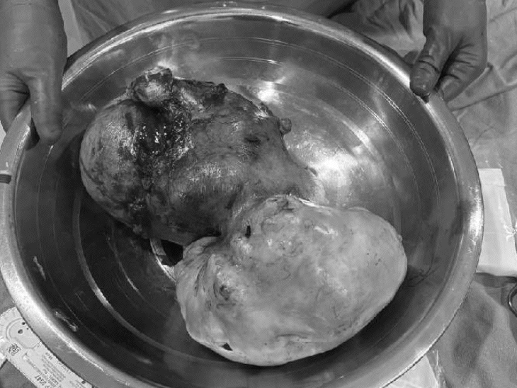 Indore Woman Surgery | Doctors Remove 8-Month Pregnancy Size Fibroid