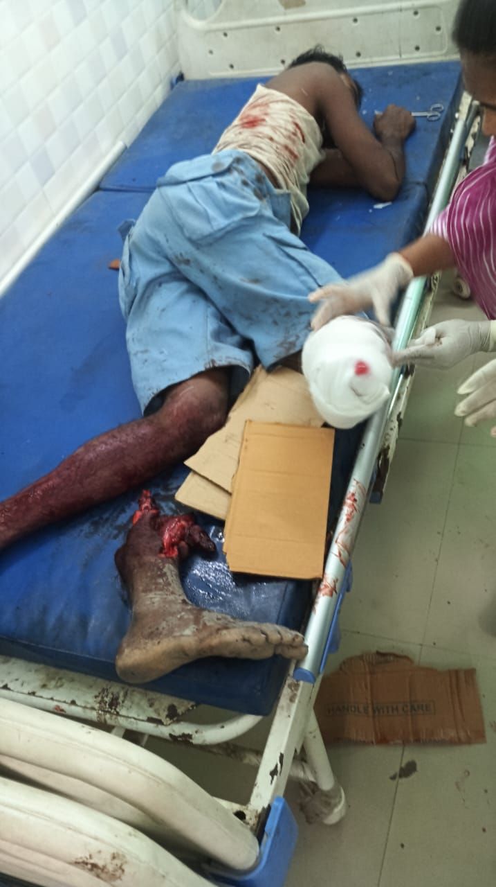Young man's leg amputated in Sonbarsa, three referred