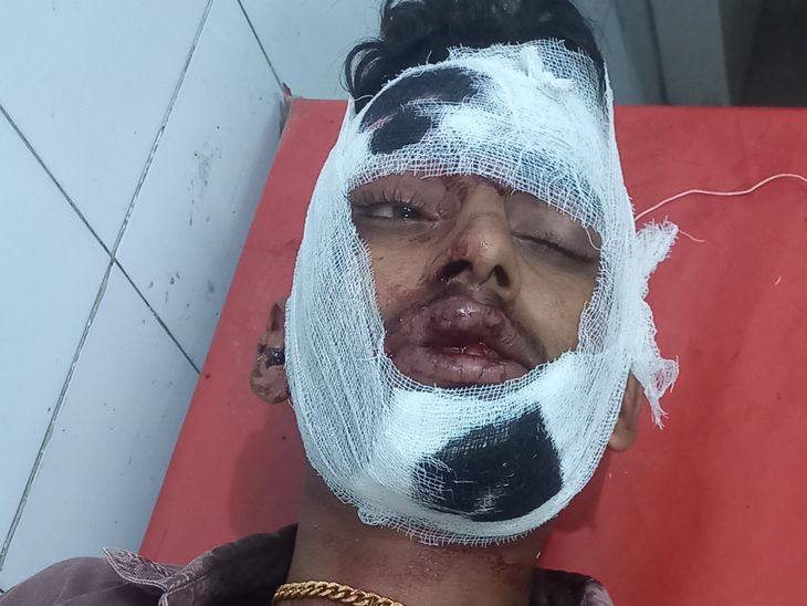 Shahabad Tanda Village Accident | Five Injured in Bike Collision