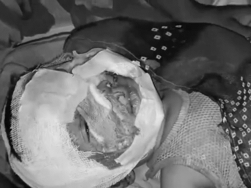 Babys Face Mauled by Jackal in Rajasthan; 20 Stitches