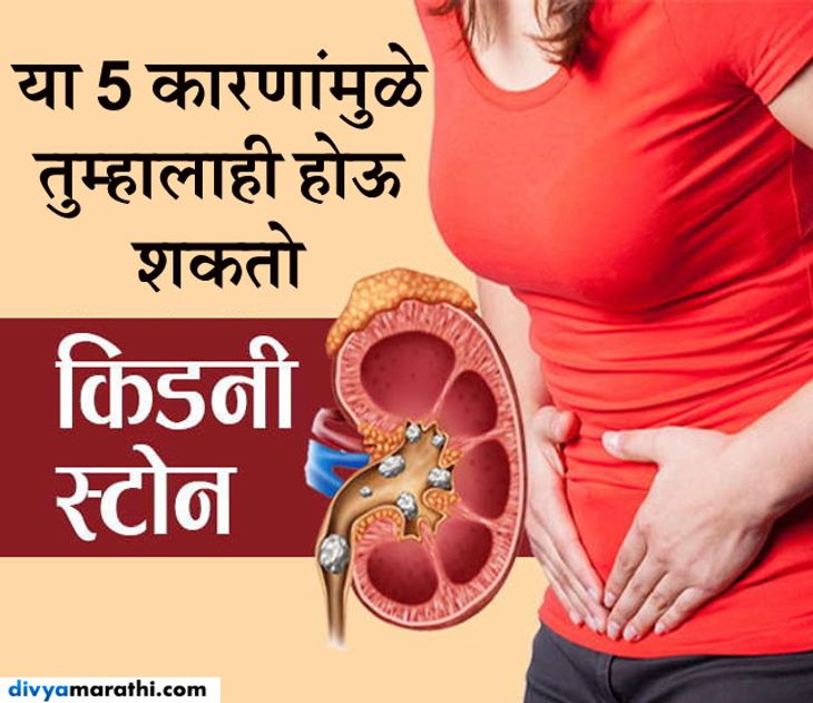 Why You Have A Kidney Stone And How To Prevent It | या 5 कारणांमुळे होऊ ...