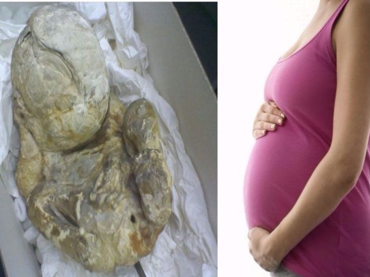 Woman Had Carried a Baby in Her Womb for 46 Years and Then Gave Birth ...