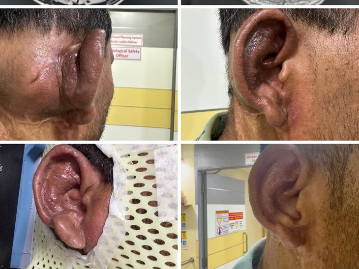 New treatment for rare ear disease | कानातील दुर्मिळ आजारावर नवे उपचार ...