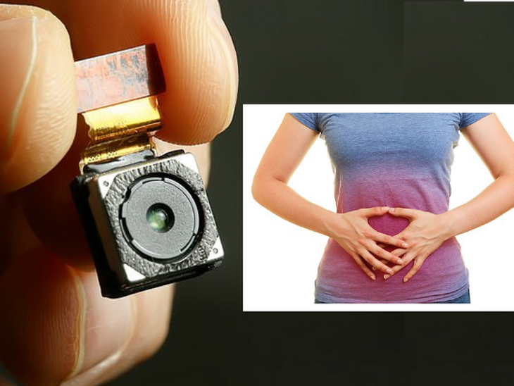 Colon Cancer Treatment; High tech Camera In The Loo Detect Of Bowel Cancer