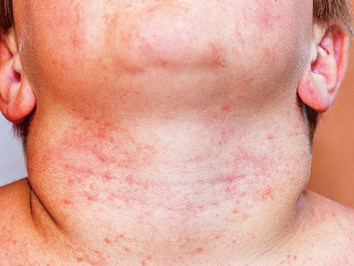 40 percent increase in cases of high grade fever, measles-like rash in ...