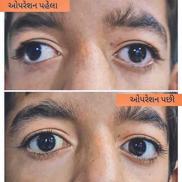 Eye problems increase 3 times due to excessive use of mobile phones and ...