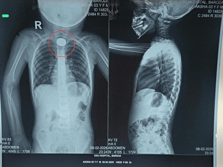 Vadodara Child Lungs Emergency Surgery: Paper Pin & Coin Cause ...