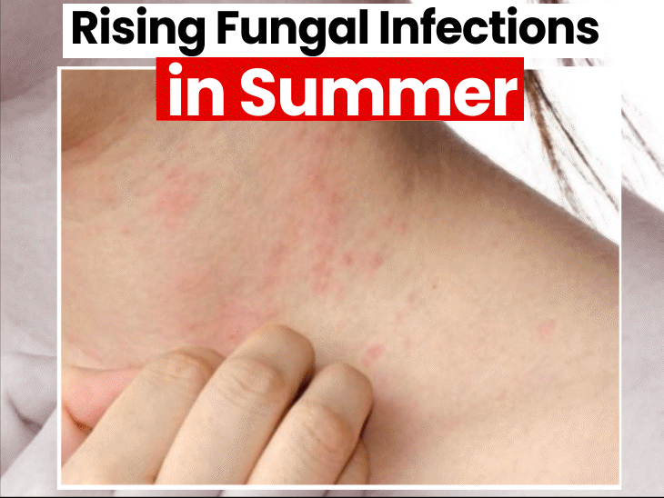 Fungal infections on rise in summer | Bhaskar English