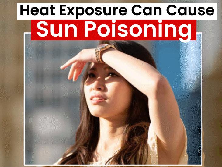 over exposure to heat and sun can lead to 'Sun Poisoning' skin expert ...