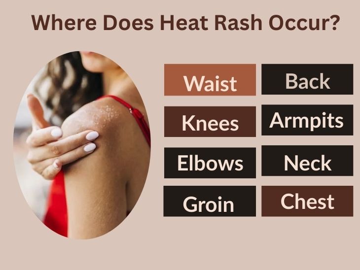 heat rash prickly heat symptoms causes children more likely to develop this skin problem in ...
