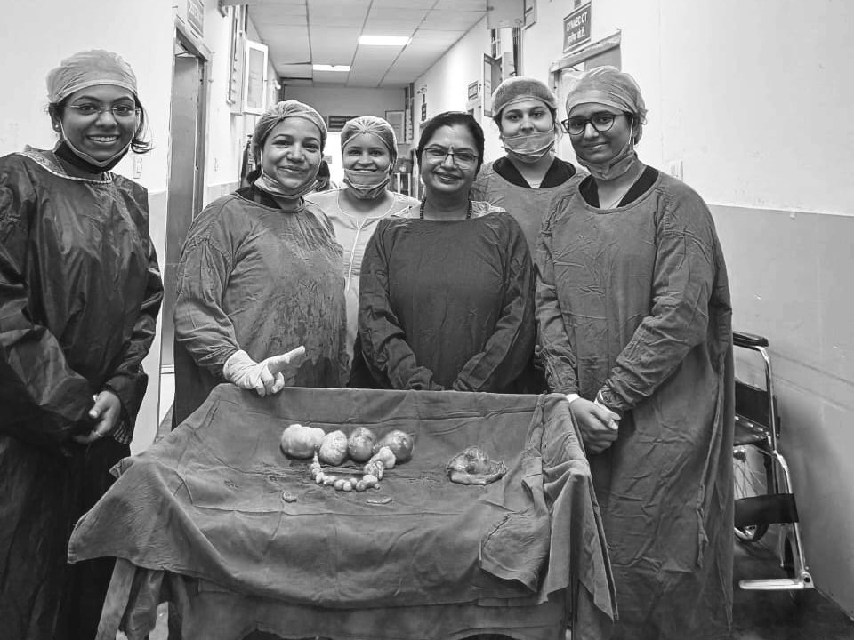 Indore doctors remove 30 fibroids from woman’s uterus: Woman suffered heavy bleeding, swollen ...