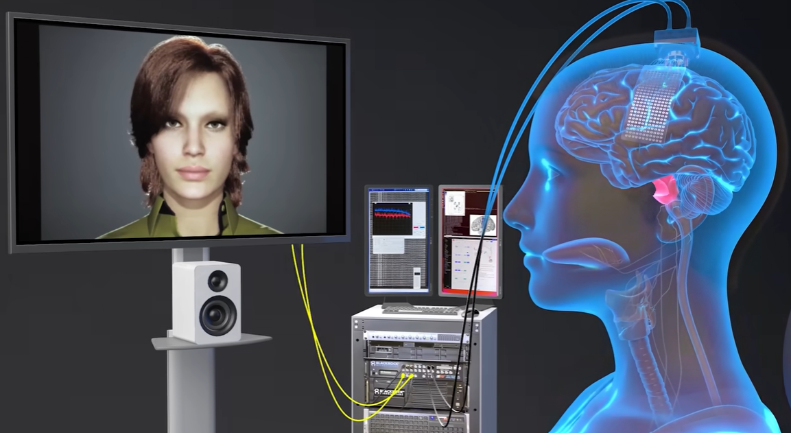 Woman regains voice with AI, 18 years after brain stroke