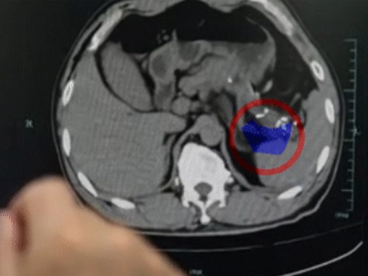 In China, AI finds deadly tumors that doctors might miss; Tool detects ...