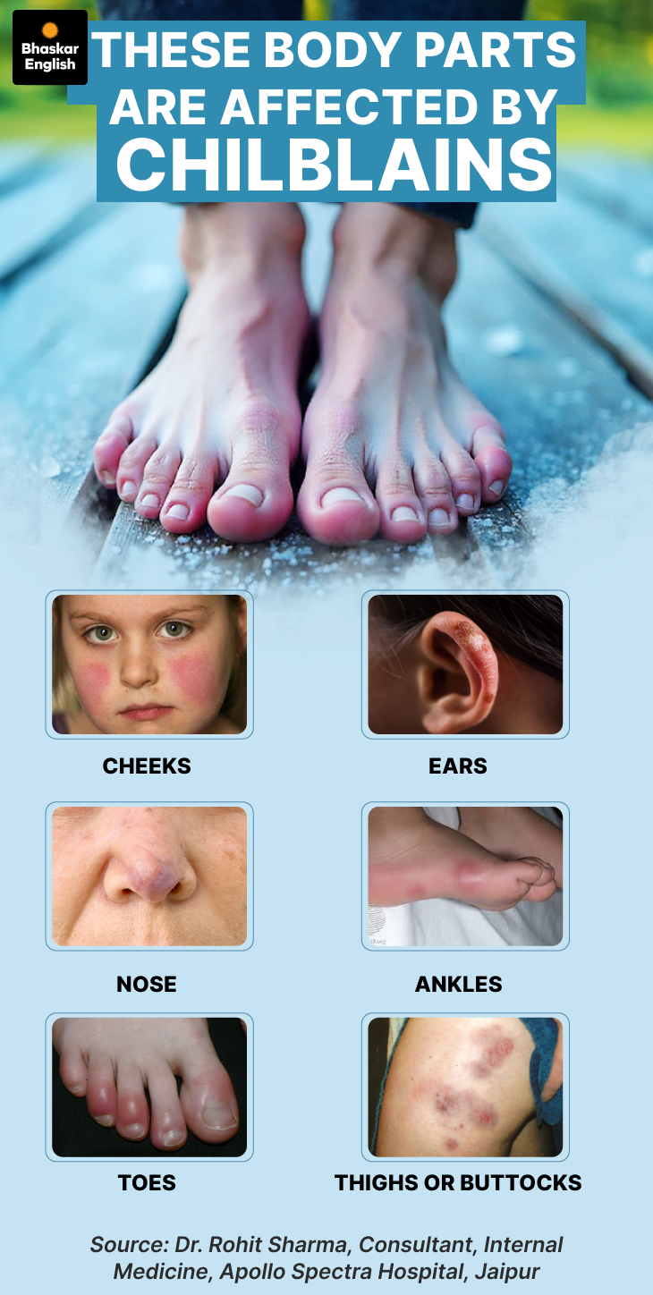 Finger Inflammation in Women: Higher Risk | Chilblains Prevention