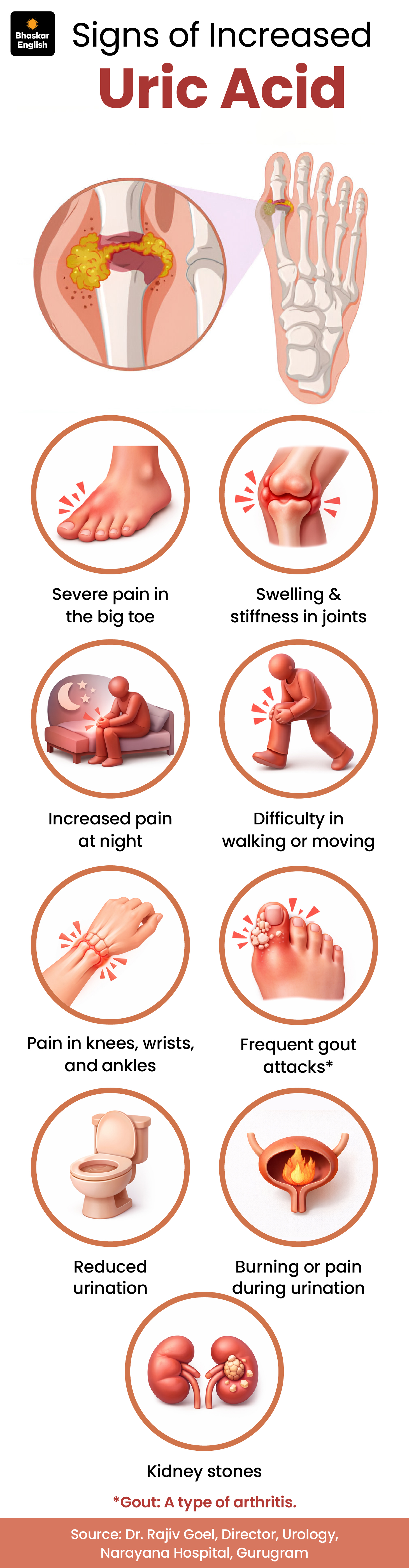 High Uric Acid Symptoms; Gout Attack Treatment | Home Remedies