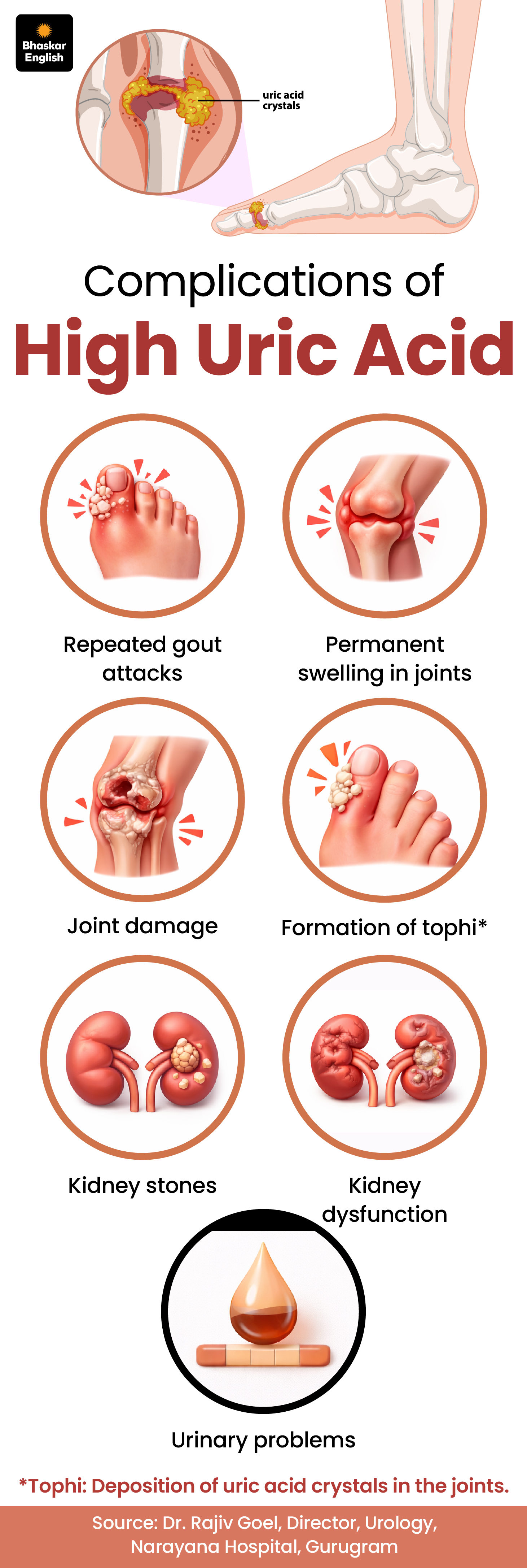 High Uric Acid Symptoms; Gout Attack Treatment | Home Remedies