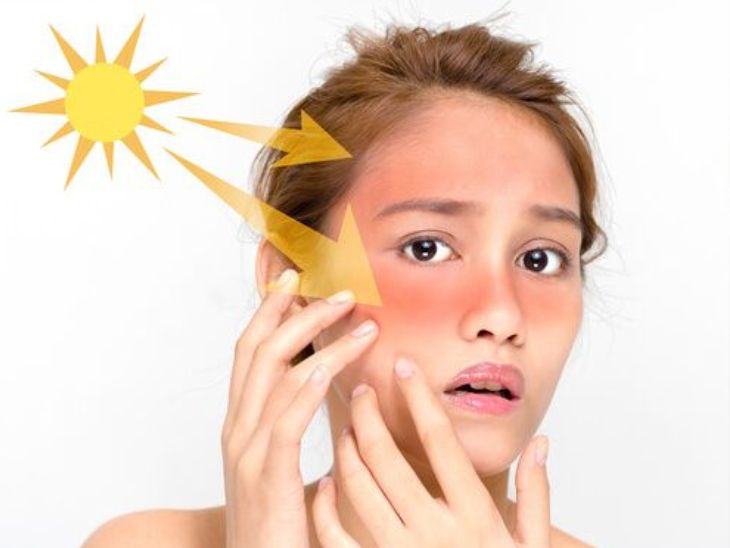 Sun Tan Removal Home Remedies Tips; Lemon Juice Honey - Aloe Vera ...