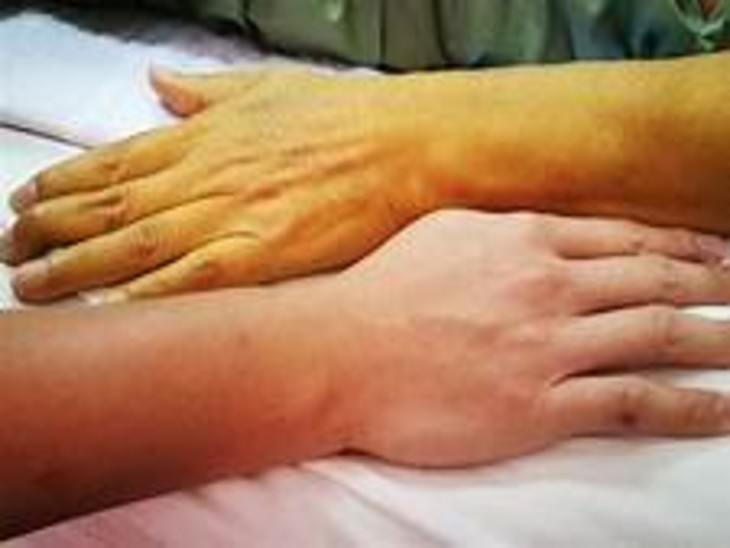 Jaundice knocks with 10 patients.
