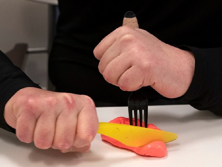 Joe DiMeo; World's First Successful Face Double Hand Transplant In ...